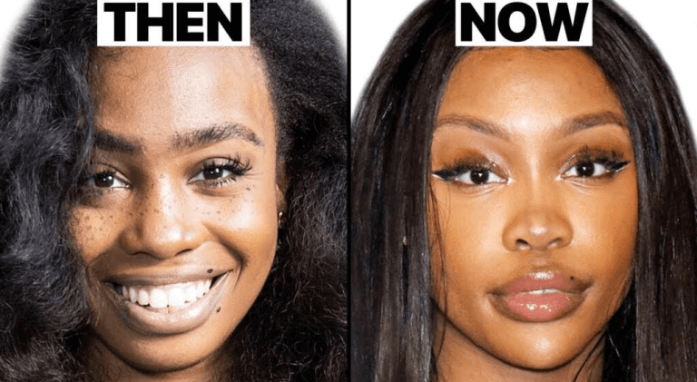 SZA Before Surgery - Did She Get A Plastic Surgery?
